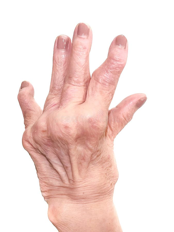 Hands and Fingers with Sequelae of Rheumatoid Arthritis, Arthrosis and ...