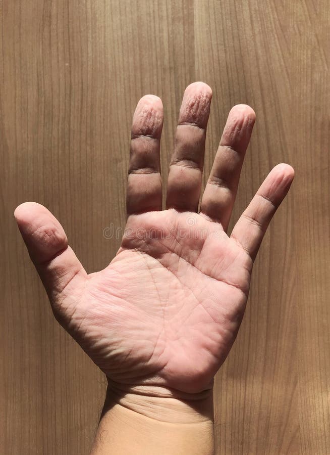 Hands that Have Been Soaked in Water for a Long Time Stock Photo ...