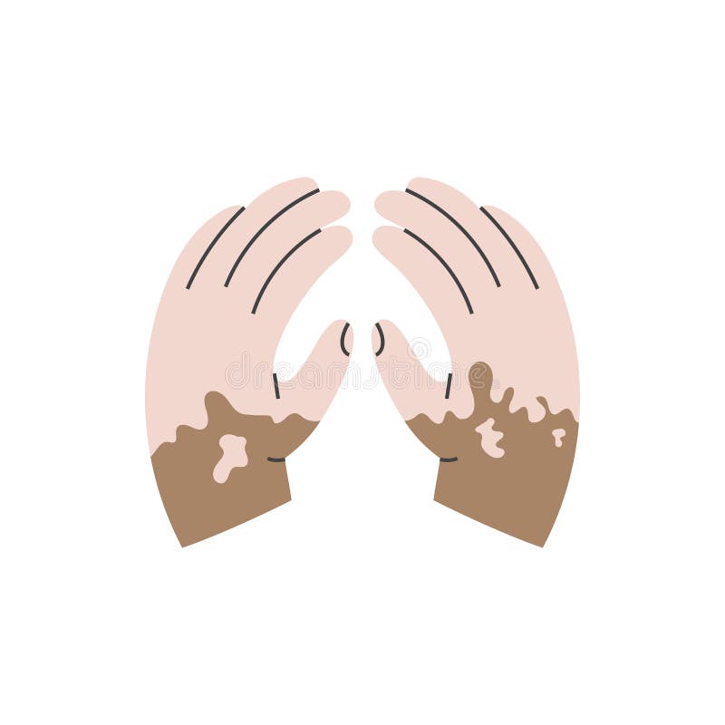 Hands with a Large Age Spot. Palm Icon with Vitiligo Stock Vector ...