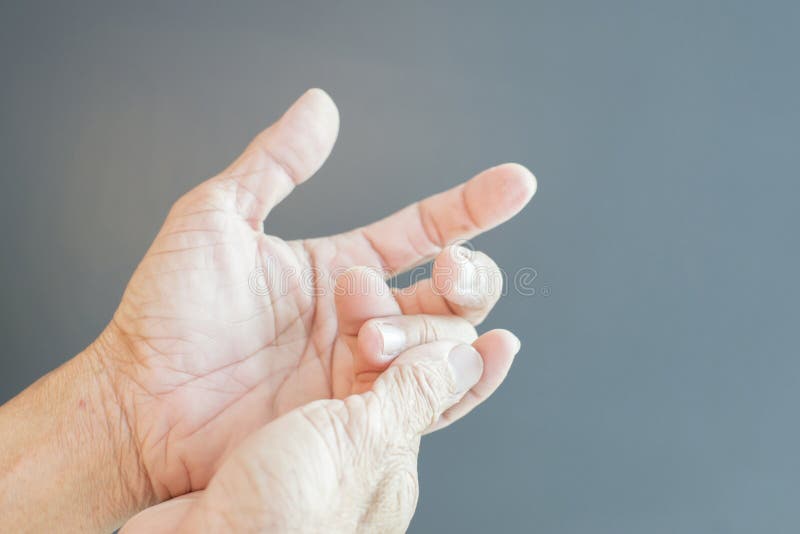 The Hands of People Who Have Problems with the Finger Bone Stock Image ...