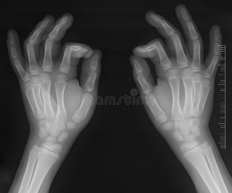 Hands x-ray stock photo. Image of medical, finger, hospital - 17555954