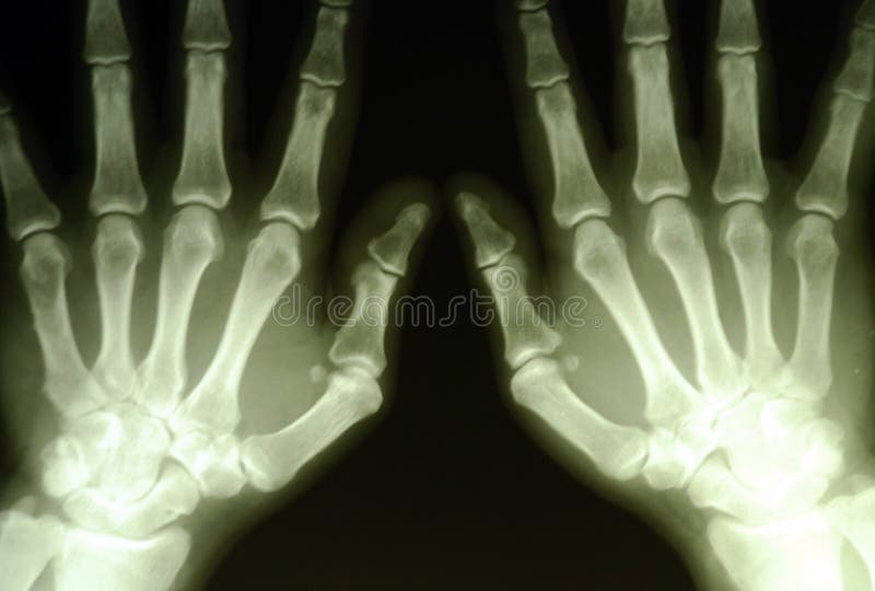 Hands roentgenogram stock image. Image of rontgen, roentgenogram - 5342685