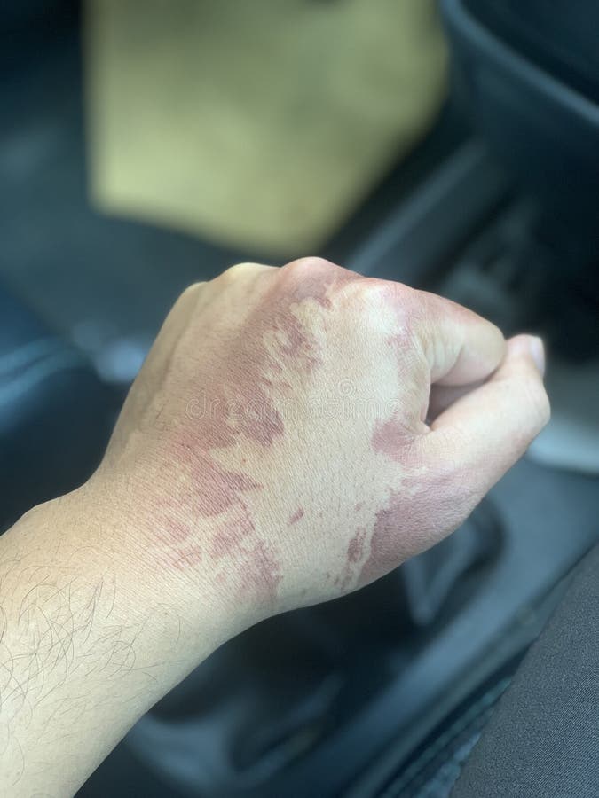 Burning hand stock image. Image of water, hands, scalded - 294450125