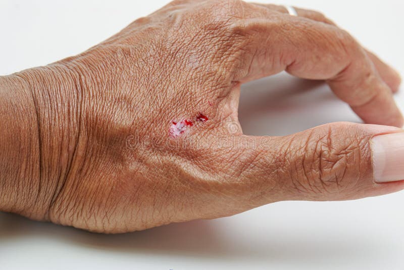Hands with Scars from Dog Bites . Stock Image - Image of white, patient ...