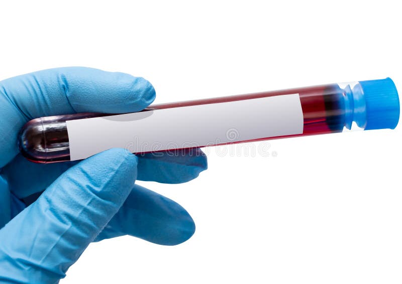 In the Hands of the Test Tubes with Blood Ready for Testing. Blood for ...