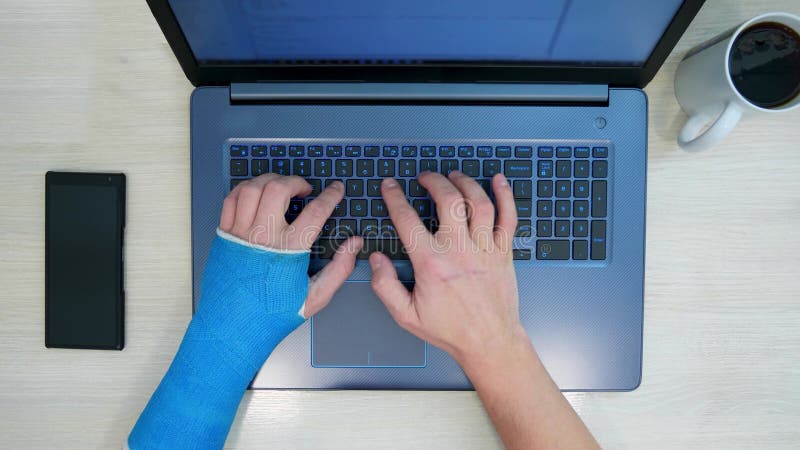Fiberglass Cast Hand Uses Laptop Stock Footage - Video of copy, plaster ...