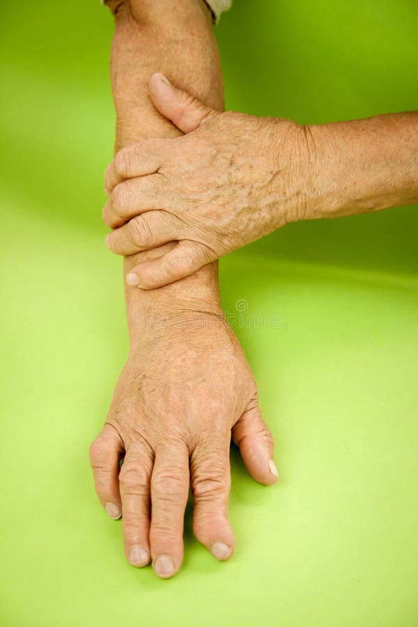 Deformed hands stock photo. Image of people, medical - 16211826