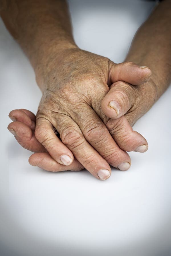 Deformed hands stock photo. Image of people, medical - 16211826