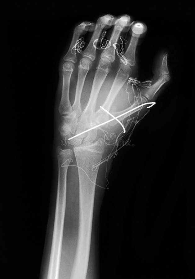 HandWires stock photo. Image of education, clinic, trauma - 1982302