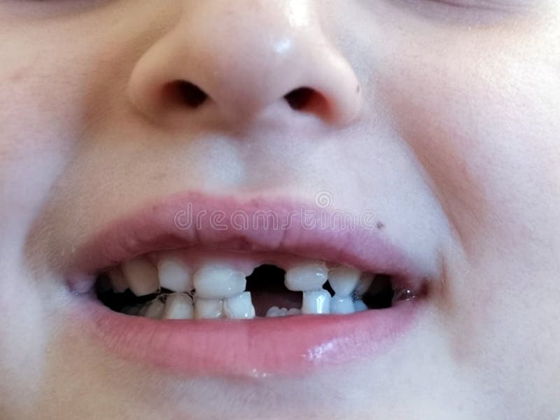 Child Proud of Missing Front Tooth Stock Photo - Image of change ...