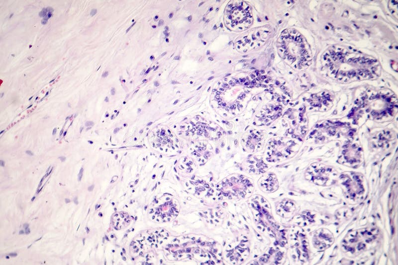 Hard Breast Cancer, Light Micrograph Stock Image - Image of hard, stain ...