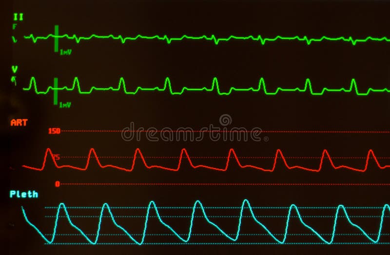 Hartmonitor Met Intraventricular Geleidingsvertraging Op ...