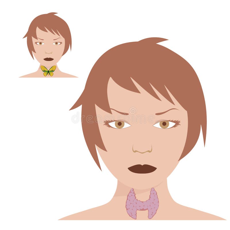 Hashimotos disease stock vector. Illustration of hashimoto - 76205169