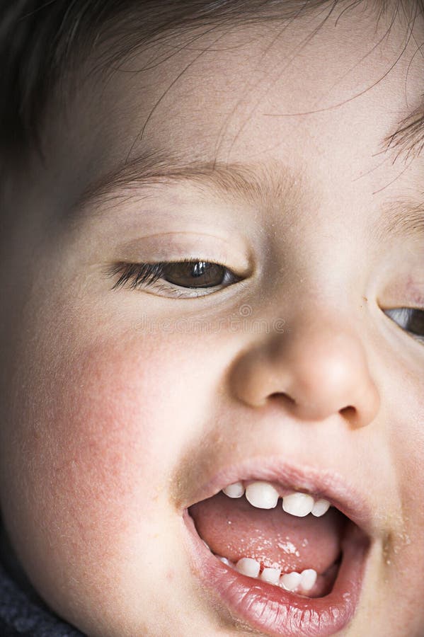 Traces Des Allergies Alimentaires Et De La Dermatite Atopique Sur Le ...