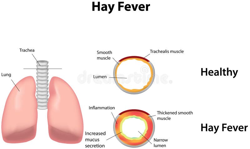 Hay fever stock vector. Illustration of epithelia, histamine - 42268713