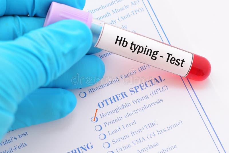 Hb typing test stock photo. Image of scientific, disease - 102807498