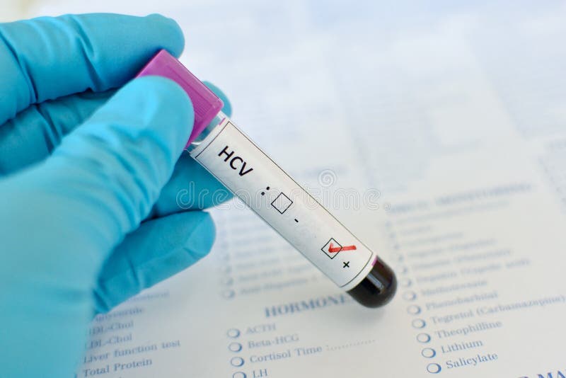 HCV positive stock image. Image of blood, hematology - 55278737