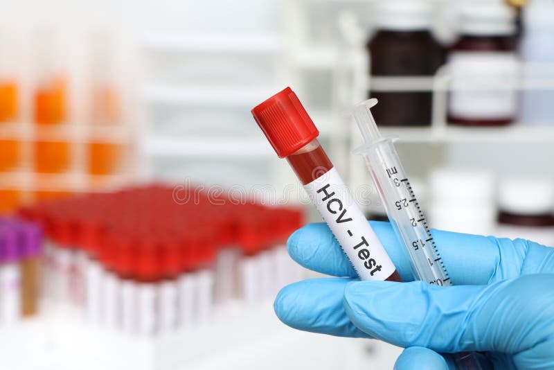 HCV Test To Look for Abnormalities from Blood Stock Photo - Image of ...