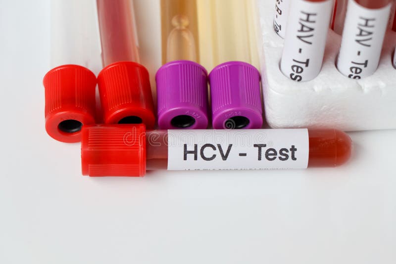 HCV Test To Look for Abnormalities from Blood Stock Photo - Image of ...