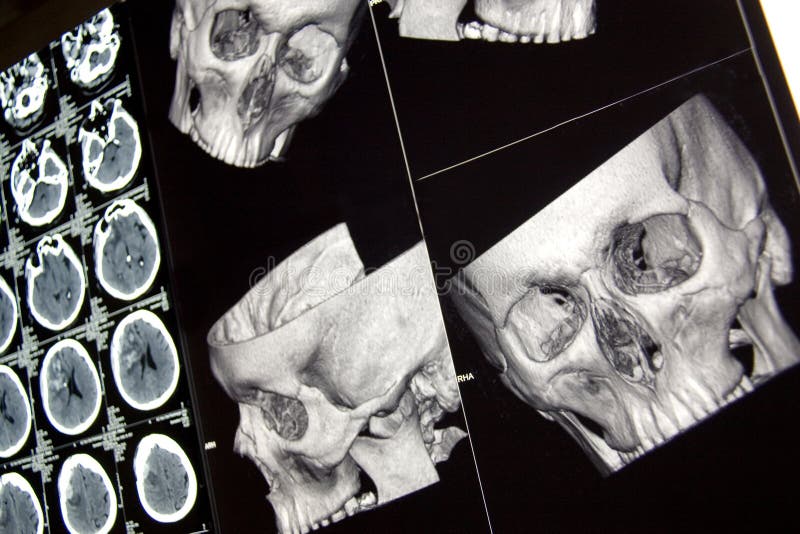 Traumatic Brain Injury, Head Bones and Brain, CT Stock Image - Image of ...
