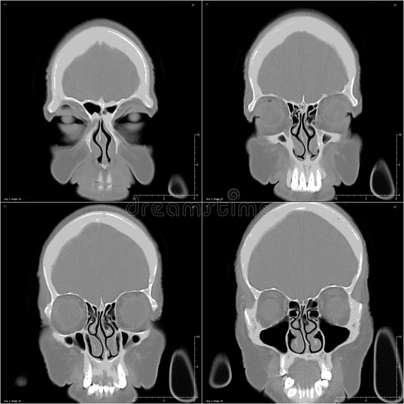 CT head image stock image. Image of diagnosis, brain - 139899837