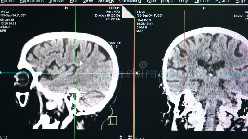 Pictures of the Brain Scan on the Monitor. Stock Footage - Video of ...