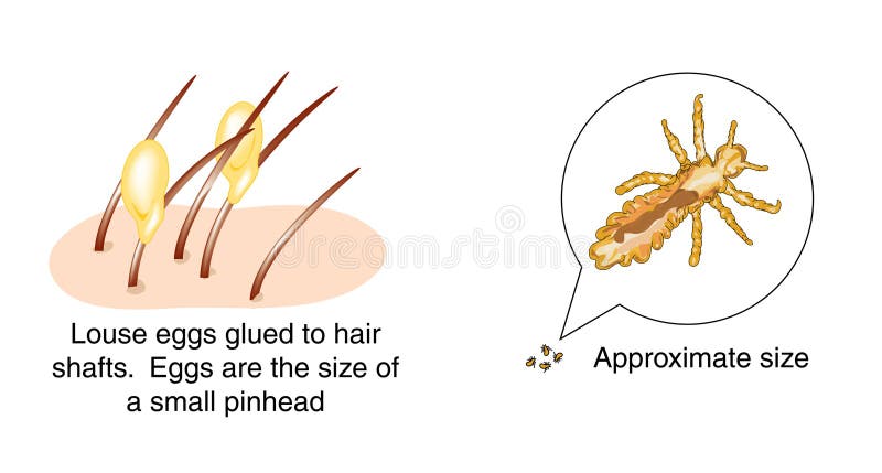 Head louse stock vector. Illustration of shaft, skin - 12907656