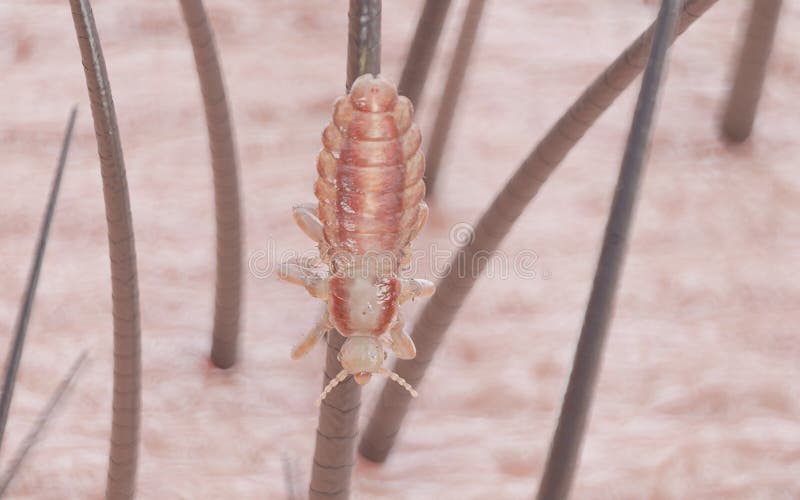A head louse stock illustration. Illustration of dermatology - 165074573