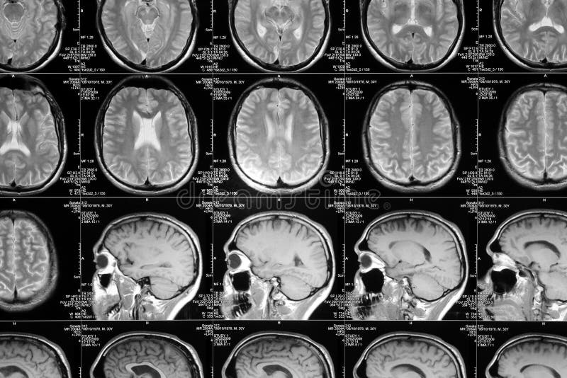Head Magnetic Resonance Image Stock Photo - Image of healthcare ...