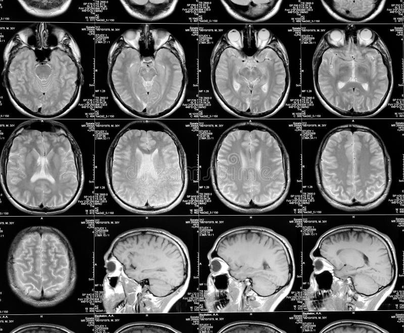 Film MRI ( Magnetic Resonance Imaging ) of Brain ( Stroke , Brain Tumor ...