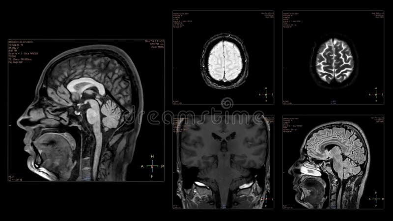 Head MRI Scan from Different Angles Stock Footage - Video of face ...