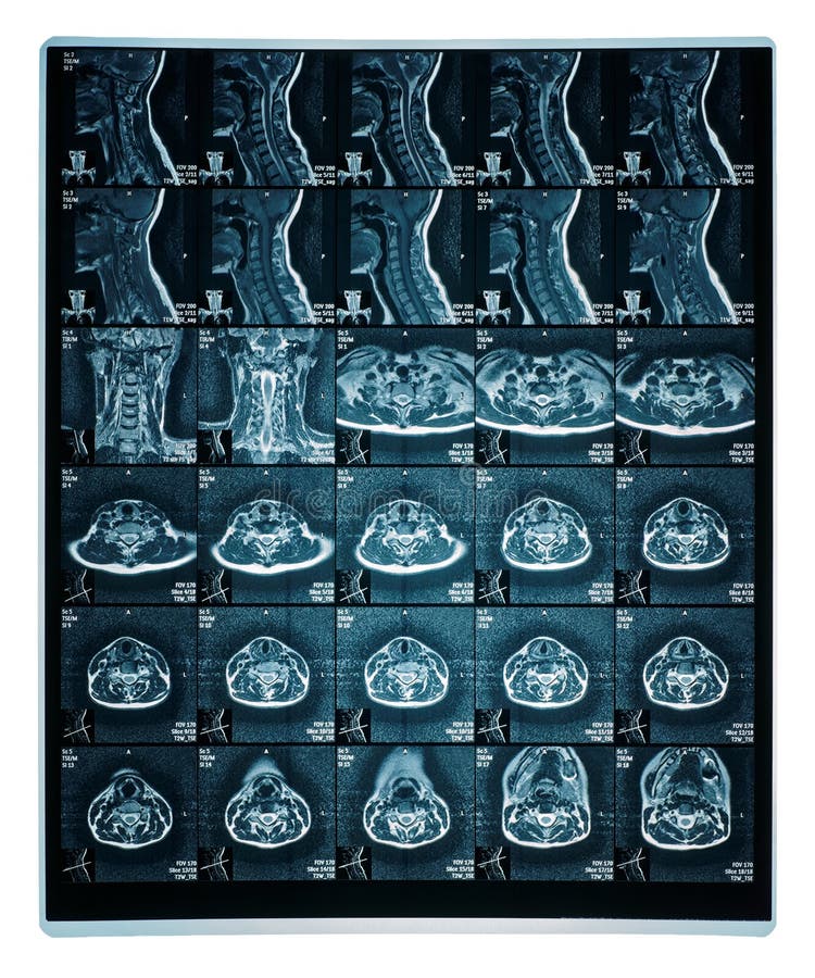 Head and Neck MRI Scan, Anonymized Stock Photo - Image of medulla ...