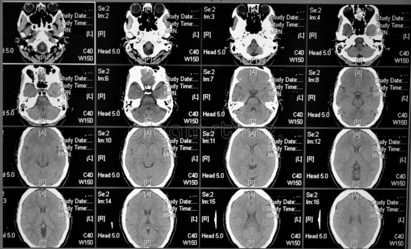 Head scan stock image. Image of diagnostic, angiogram - 87489281