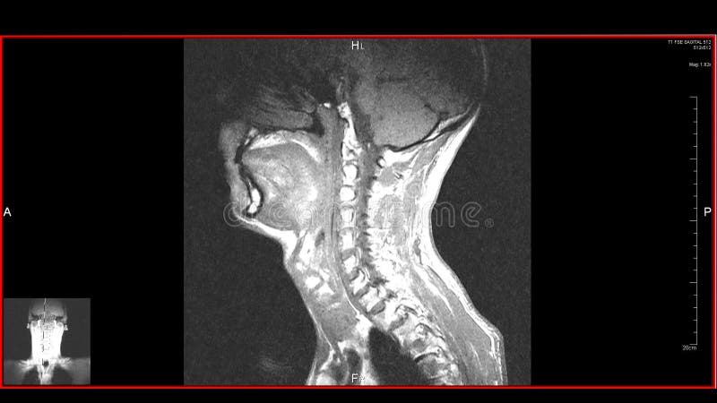 Head top MRT scan stock footage. Video of exam, backgrounds - 81044624