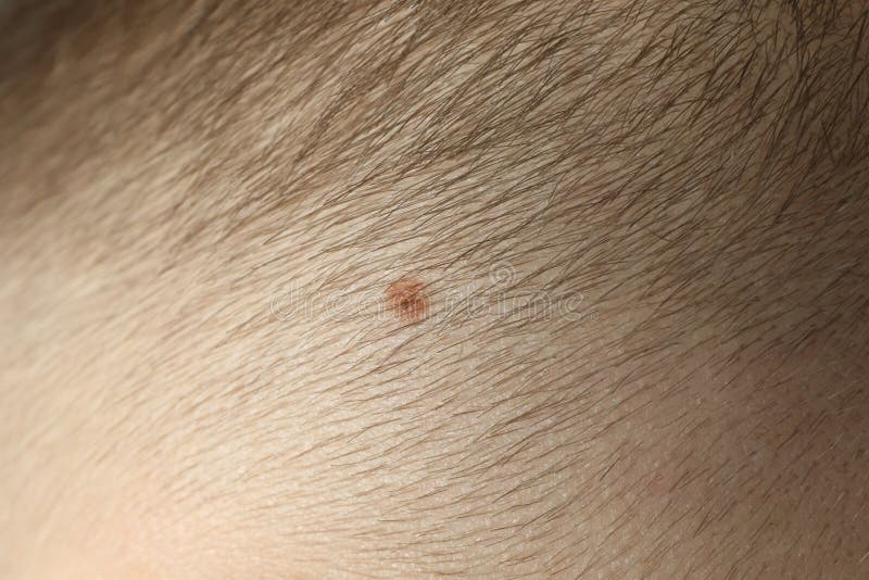 Head of Young Man with Mole, Close Up Stock Image - Image of growth ...