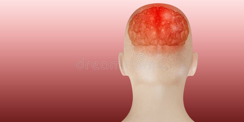 Skull, Pain, Headaches, Neurons, Synapses, Neural Network, Brain ...