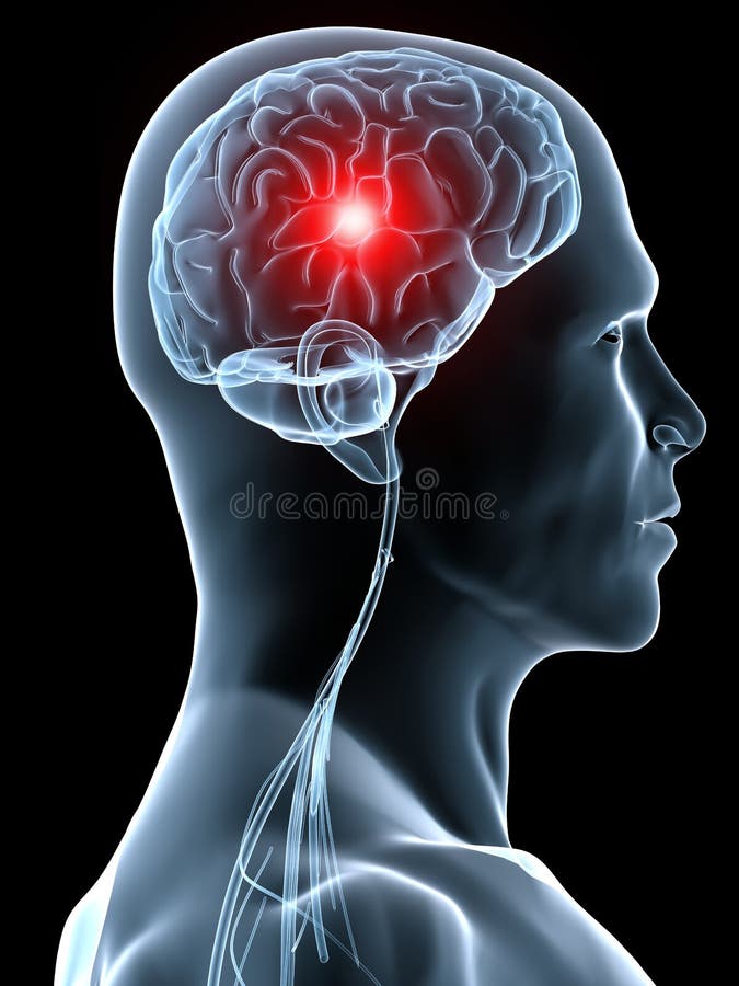 Headache / migraine stock illustration. Illustration of physiology ...