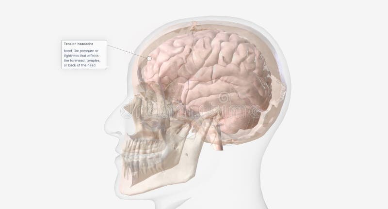 Headaches, Known As Tension Type, Affect the Forehead, Temples, and ...