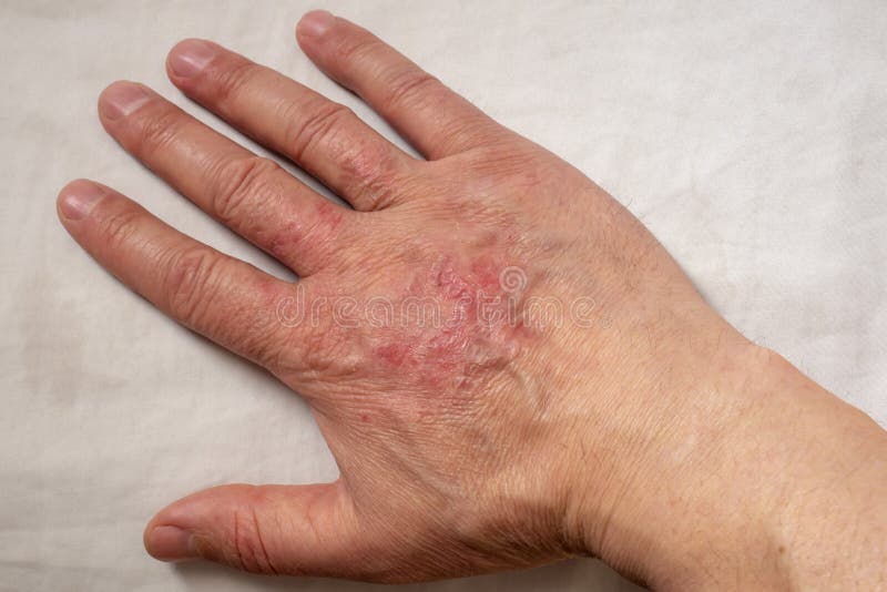 Burns Wound Hospital Stock Photos - Free & Royalty-Free Stock Photos ...