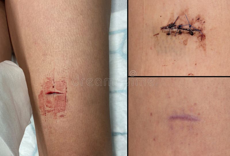 Healing Process of Cut on Thigh with Stitches and Building of Scar ...