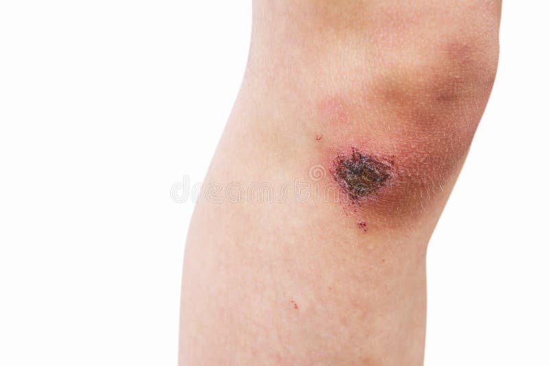 Healing scab stock photo. Image of wound, scabbing, hurt - 17757490