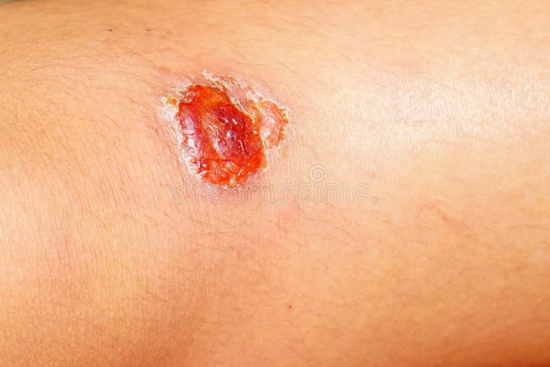 Healing scab stock image. Image of isolated, fresh, illness - 62476577