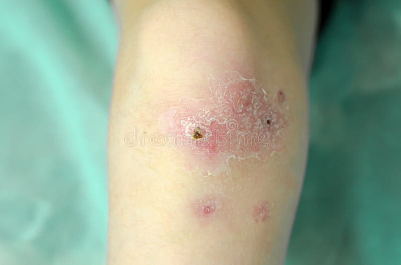 Healing Wounds on the Knee of a Child Stock Photo - Image of caucasian ...