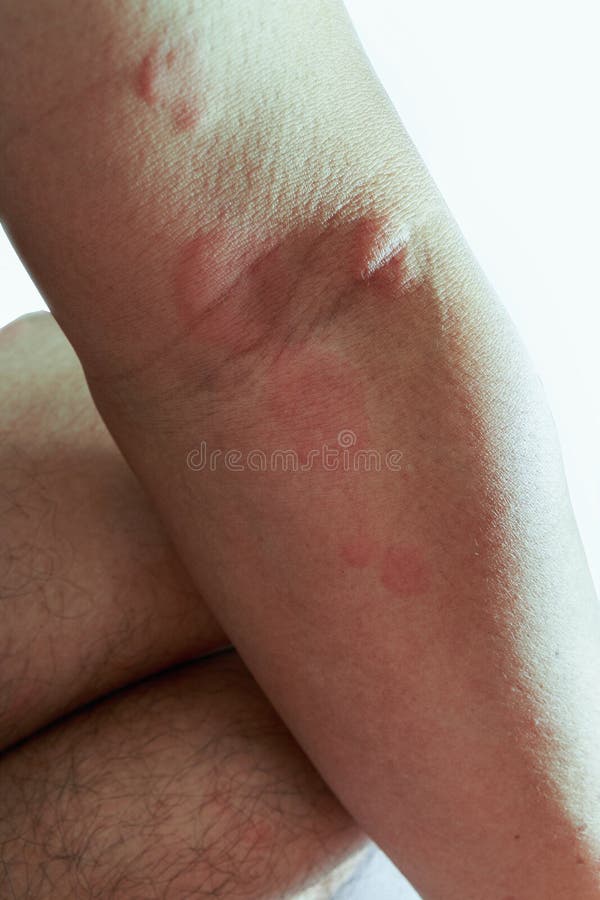 Around Legs Allergy Rash and Health Problem. Stock Photo - Image of ...