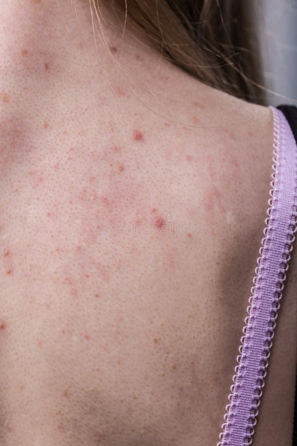 Woman with Skin Problem Acne on Back Stock Photo - Image of closeup ... Woman with Skin Problem Acne on Back Stock Photo - Image of closeup ...
