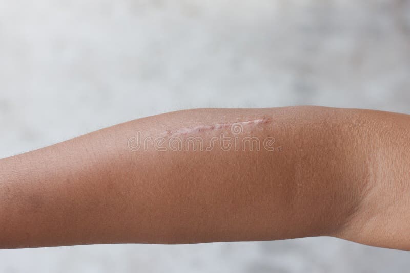 Health stock photo. Image of traces, wounds, clinic, marks - 92893776