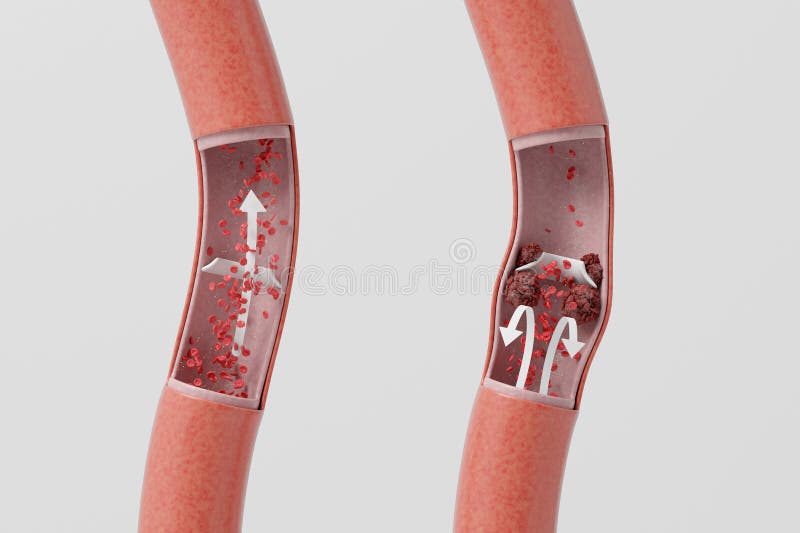 Blocked Flow Circulation Stock Illustrations – 586 Blocked Flow ...