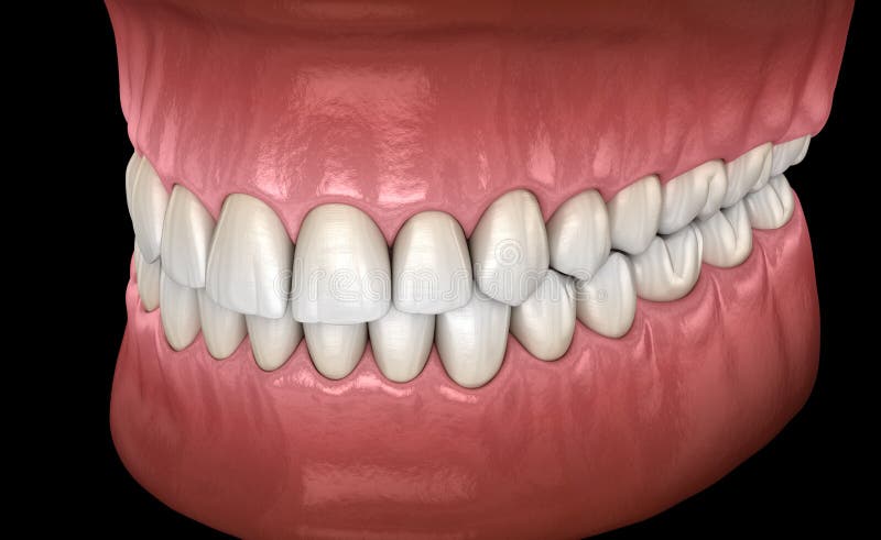 Normal Dental Occlusion 3d Stock Illustrations – 22 Normal Dental ...