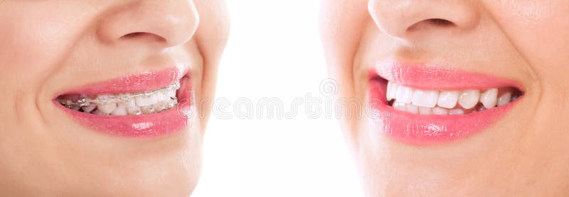 Healthy perfect teeth stock photo. Image of orthodontics - 62598534