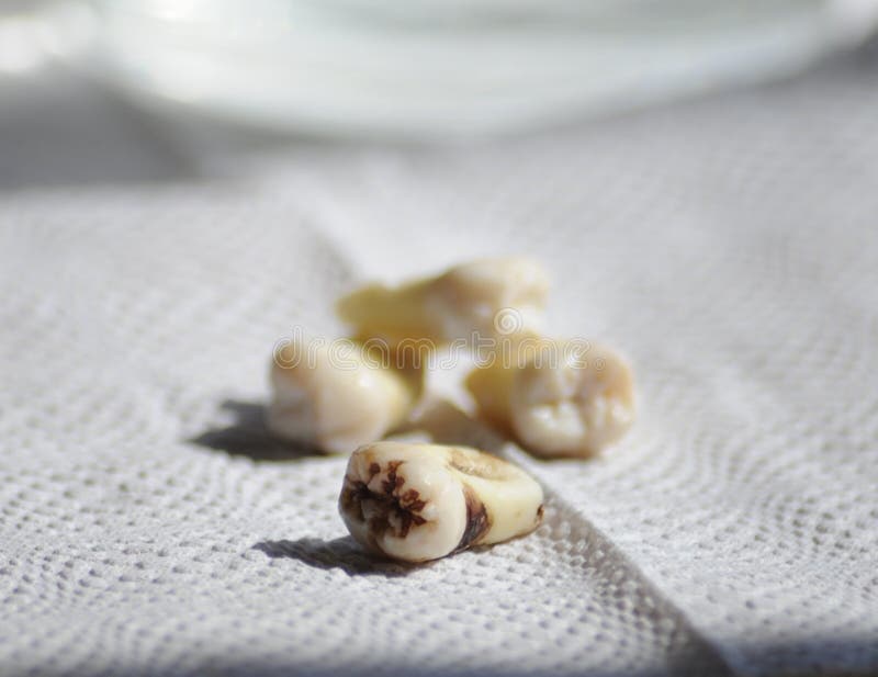 Healthy Teeth and Cavity Tooth on White Dentist Background Stock Image ...